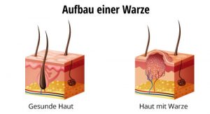 Warzen – welche Arten gibt es? - Bodfeld Apotheke Blog